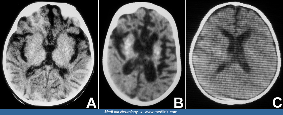 Aicardi-Goutieres Syndrome | MedLink Neurology
