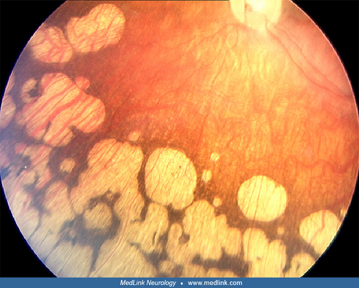 Hyperornithinemia | MedLink Neurology