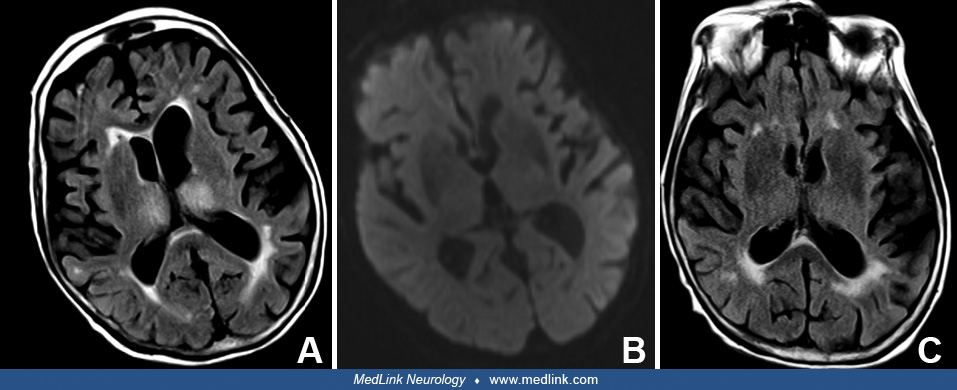 Hypertensive encephalopathy | MedLink Neurology