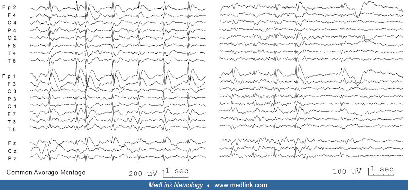 Cloned-like repetitive multifocal spike-wave complexes in two children ...