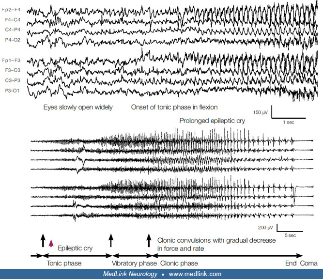 Icd 10 Code For Grand Mal Epilepsy 2021 Icd 10 Code For Grand Mal Epilepsy 2021