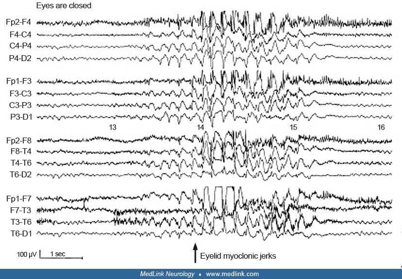 Seizure in eyelid myoclonia with absences (EEG) | MedLink Neurology