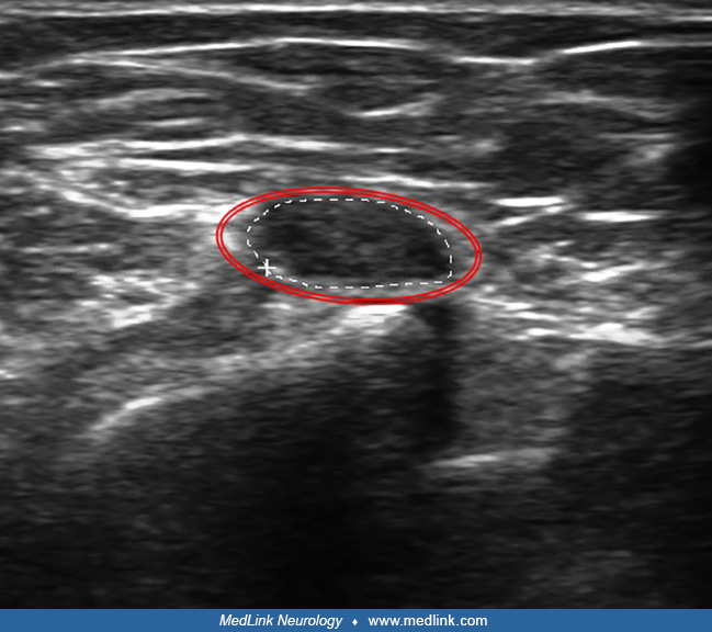 Radiologic Abnormalities In Patients With… | MedLink Neurology