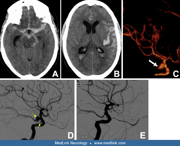 Subarachnoid Hemorrhage Subarachnoid Hemorrhage