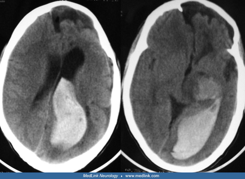 Traumatic Intracranial Hemorrhage Traumatic Intracranial Hemorrhage