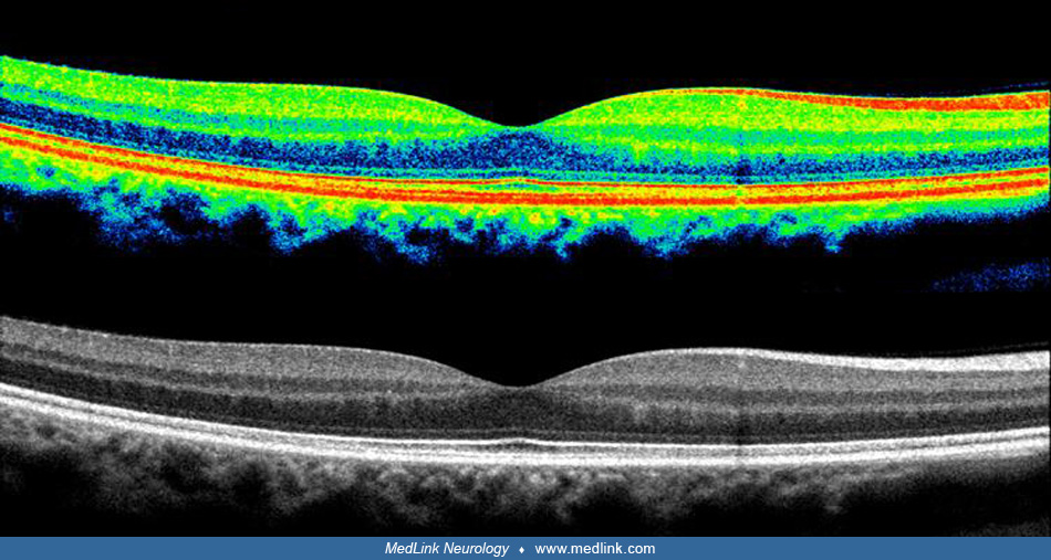 Zeiss Cirrus OCT | MedLink Neurology