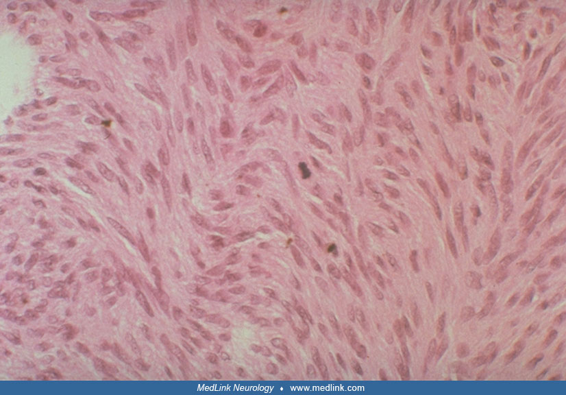 Classic schwannoma depicting a region of Antoni A (photomicrograph ...